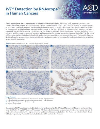 WT1 Detection by RNAscope in Human Cancers