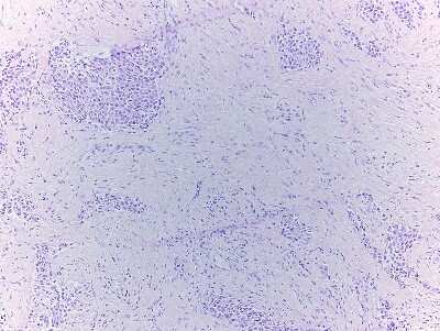 CancerSeq (TM) Breast: Slides and MicroArrays